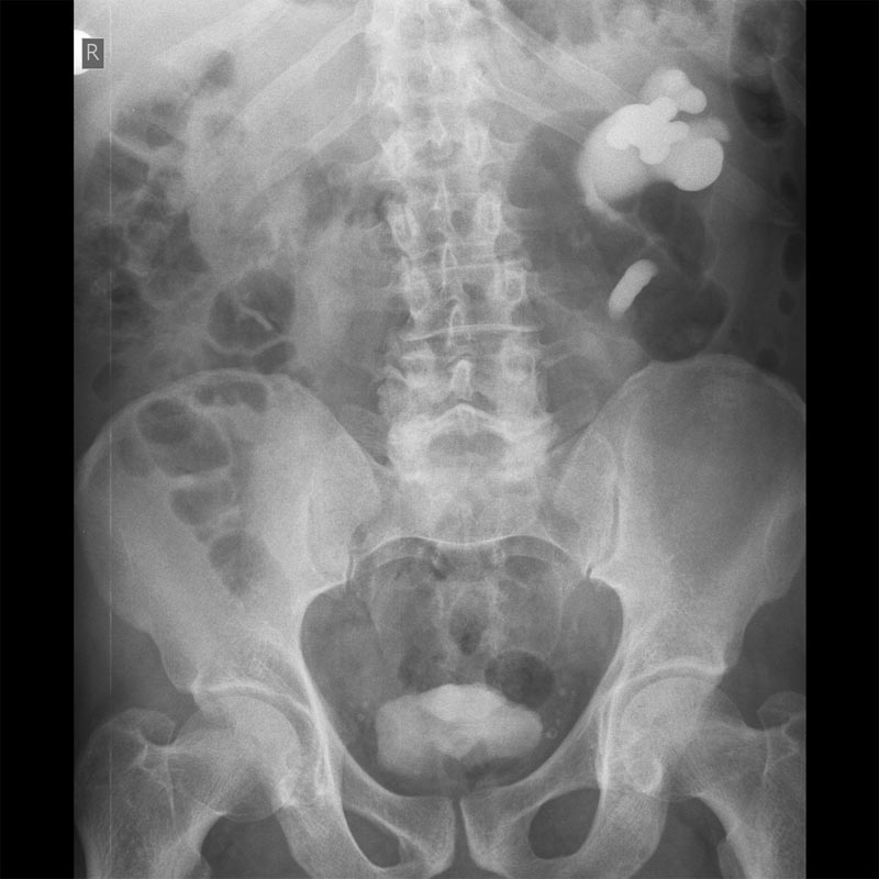 ΔΙΑΓΝΩΣΤΙΚΗ ΠΡΟΣΠΕΛΑΣΗ ΣΕ ΟΥΡΟΘΗΛΙΑΚΟ ΚΑΡΚΙΝΩΜΑ ΟΥΡΗΤΗΡΑ ΜΕ MR ...