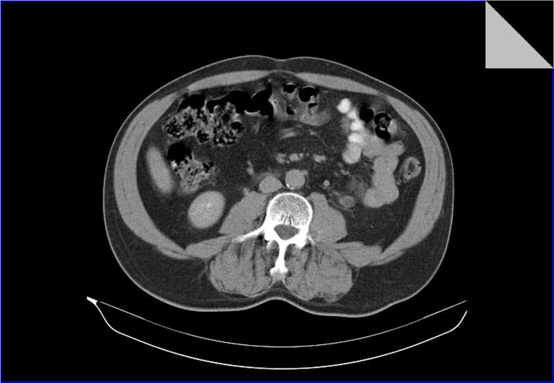 ΔΙΑΓΝΩΣΤΙΚΗ ΠΡΟΣΠΕΛΑΣΗ ΣΕ ΟΥΡΟΘΗΛΙΑΚΟ ΚΑΡΚΙΝΩΜΑ ΟΥΡΗΤΗΡΑ ΜΕ MR ...