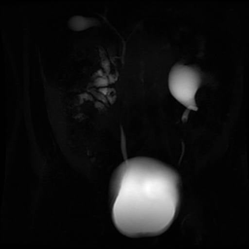 ΔΙΑΓΝΩΣΤΙΚΗ ΠΡΟΣΠΕΛΑΣΗ ΣΕ ΟΥΡΟΘΗΛΙΑΚΟ ΚΑΡΚΙΝΩΜΑ ΟΥΡΗΤΗΡΑ ΜΕ MR ...