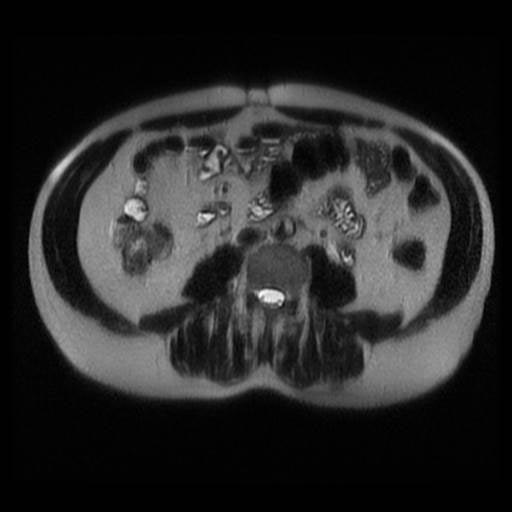 ΔΙΑΓΝΩΣΤΙΚΗ ΠΡΟΣΠΕΛΑΣΗ ΣΕ ΟΥΡΟΘΗΛΙΑΚΟ ΚΑΡΚΙΝΩΜΑ ΟΥΡΗΤΗΡΑ ΜΕ MR ...