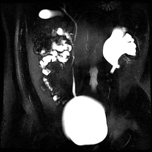 ΔΙΑΓΝΩΣΤΙΚΗ ΠΡΟΣΠΕΛΑΣΗ ΣΕ ΟΥΡΟΘΗΛΙΑΚΟ ΚΑΡΚΙΝΩΜΑ ΟΥΡΗΤΗΡΑ ΜΕ MR ...