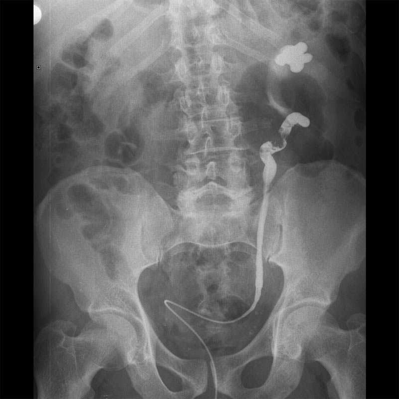 ΔΙΑΓΝΩΣΤΙΚΗ ΠΡΟΣΠΕΛΑΣΗ ΣΕ ΟΥΡΟΘΗΛΙΑΚΟ ΚΑΡΚΙΝΩΜΑ ΟΥΡΗΤΗΡΑ ΜΕ MR ...